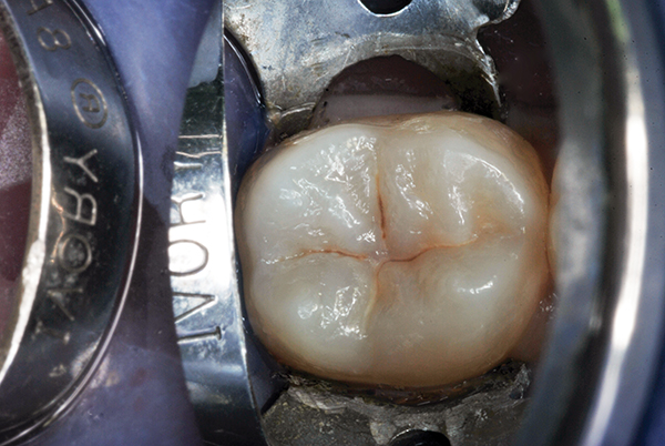 Biomimetic Tooth Repair | Inside Dentistry