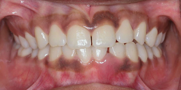 Treatment of Localized Aggressive Periodontitis | Inside Dentistry