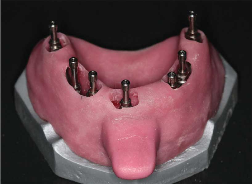 Capturing Open Tray Impressions for Implant-Supported Prostheses ...