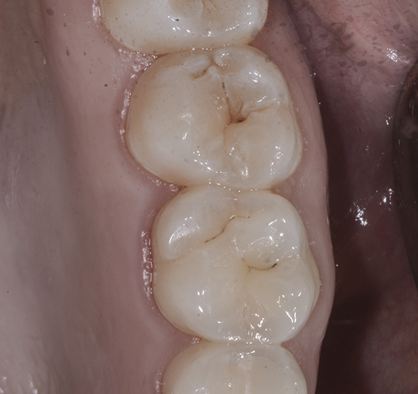 Early Detection and Treatment of Caries | Inside Dentistry