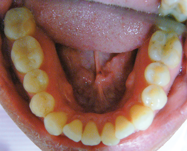 Performing Orthodontics While Treating OSA | Inside Dentistry