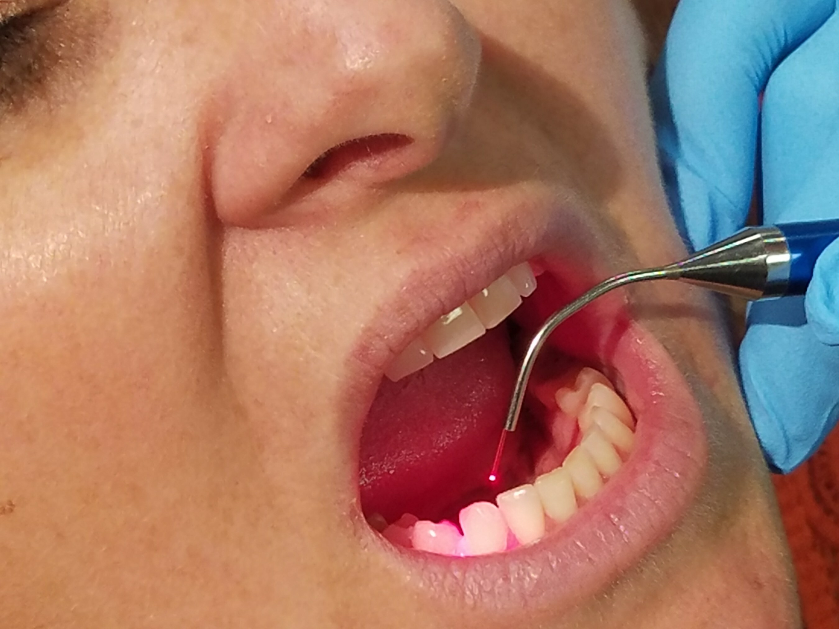 Millennium Dental Technologies to Award 100 LANAP® Treatment ...