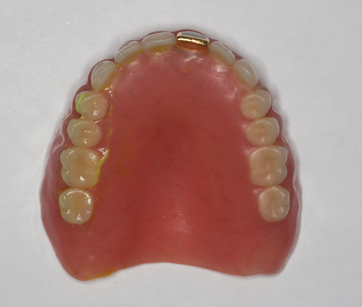 Fabricating New Dentures From Existing Ones | Inside Dentistry