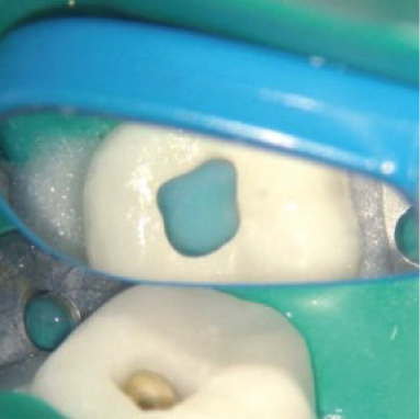 Introducing EndoSequence® BC Liner™ Blue | Inside Dentistry