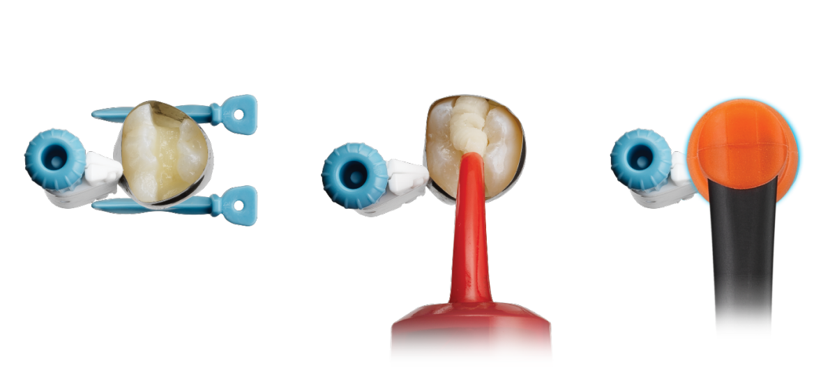 Dentsply Sirona’s new Surefil one: An innovation in restorative filling ...