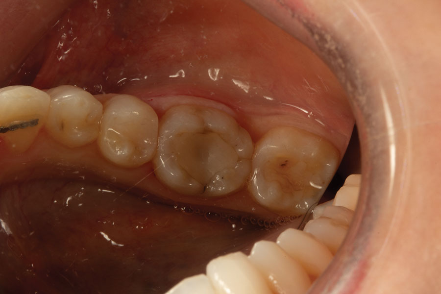 Placing Conservative Posterior Zirconia Restorations | Inside Dentistry