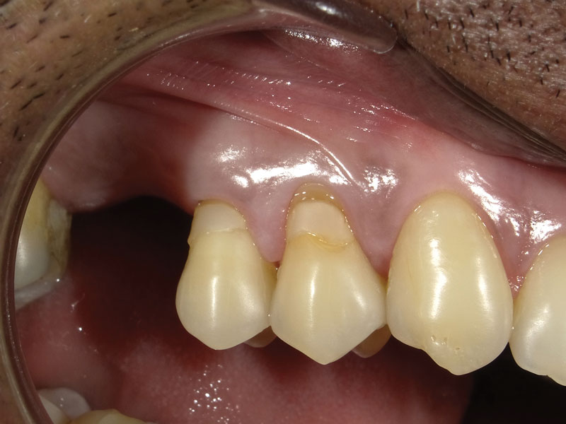 Re-treatment of Failing Class V Restorations With Gingival Recession ...