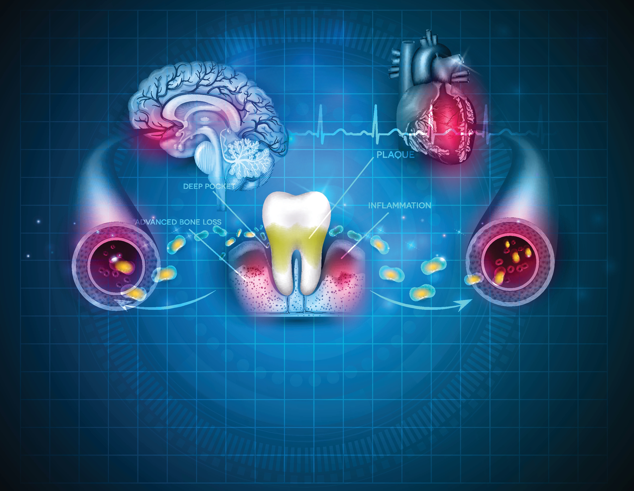 Study Links Gum Disease and Caries to Higher Stroke Risk | Inside Dentistry