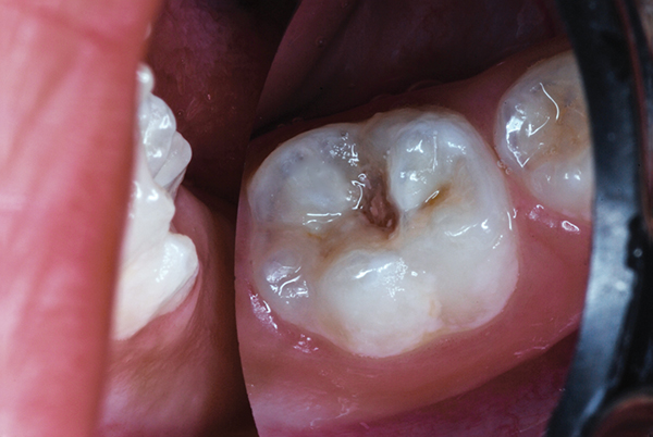 Primary Molar Pulpotomy | Inside Dentistry