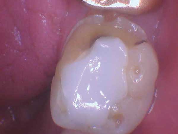 Fully Digital Same-Day Restorative Dentistry | Inside Dentistry