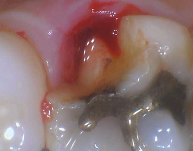 Treating a Fractured Molar | Inside Dentistry