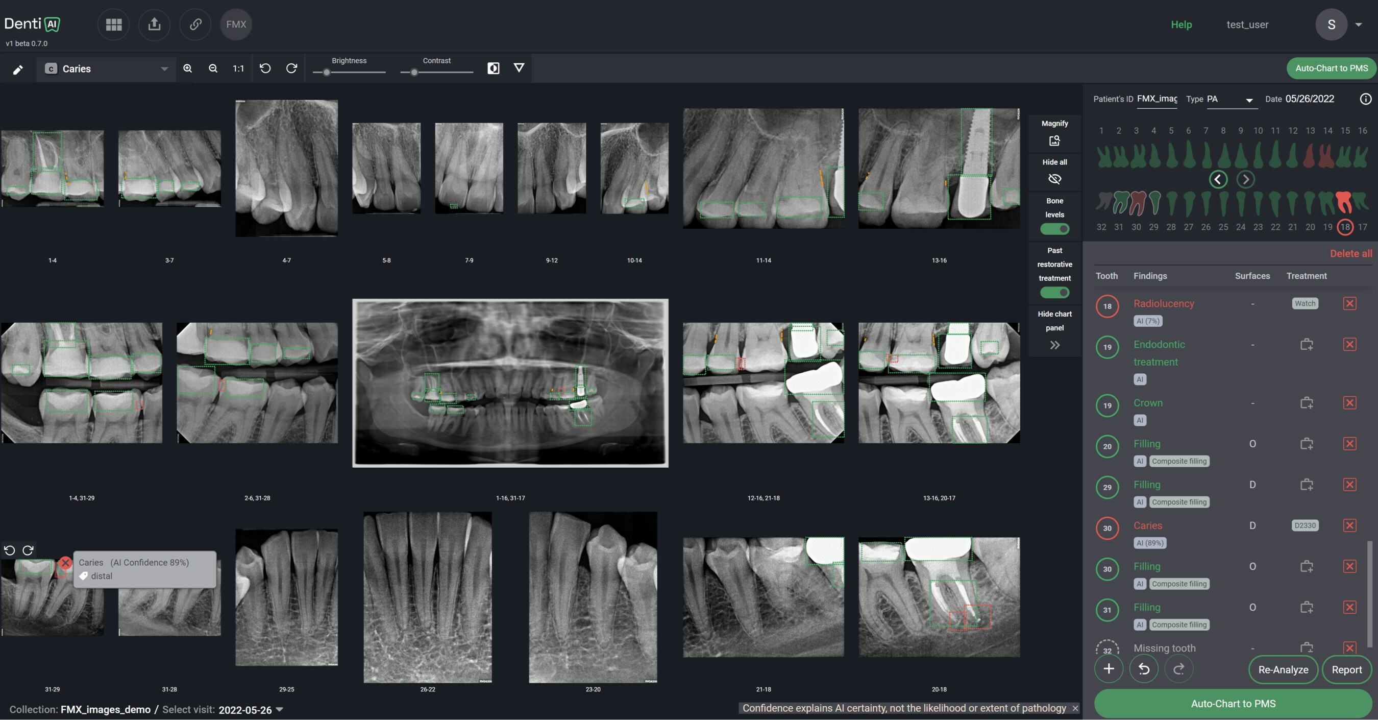 Denti.AI Pioneers FDA-cleared Pathology Detection in Both Panoramic and Intraoral X-rays With ...