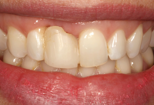Loss of the Interdental Papilla | Inside Dentistry