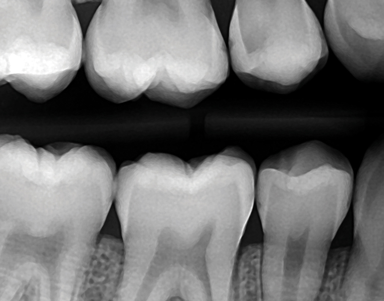 SDF for Managing Open Gingival Floor Margins in Class II Restorations ...