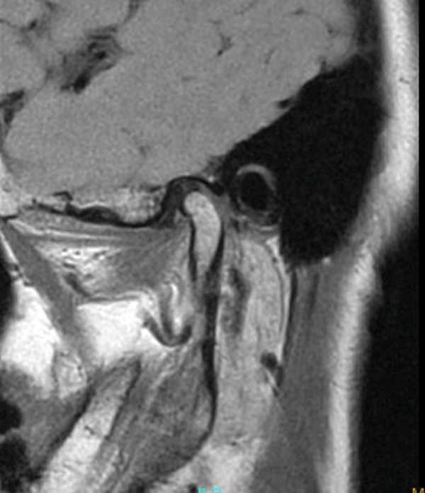 Treating Nonreducing Disc Displacement | Inside Dentistry