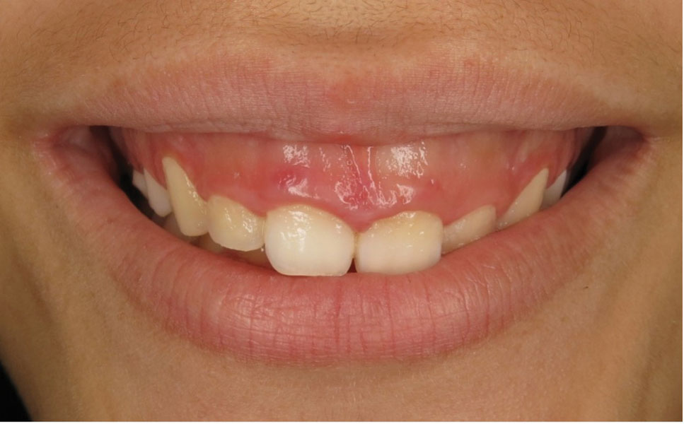 Treating Excessive Gingival Display Without Orthognathic Surgery ...