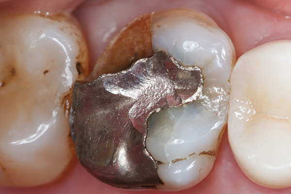 Re-Treatment of a Failing Posterior Amalgam Restoration | Inside Dentistry
