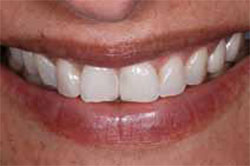 Conservative Porcelain Indirect Restorations | Inside Dentistry