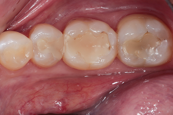 Creating Predictable Composite Contacts | Inside Dentistry