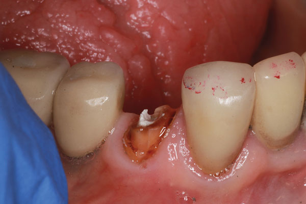Conservative Universal Post and Core Buildups | Inside Dentistry