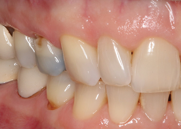 Gingival Retraction and Bacterial Reduction Therapy | Inside Dentistry