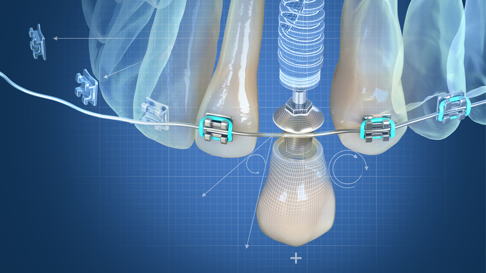 Integrating Orthodontics and Implant Dentistry | Inside Dentistry