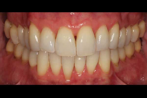 Predictable Soft-Tissue Grafting for Extreme Cases | Inside Dentistry