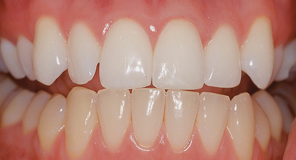 Determining Appropriate Fees for Tooth Bleaching | Inside Dentistry