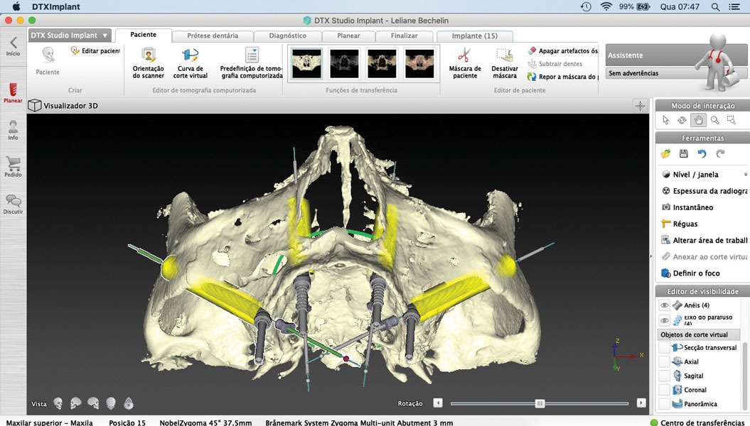 A Transnasal Implant Technique | Inside Dentistry