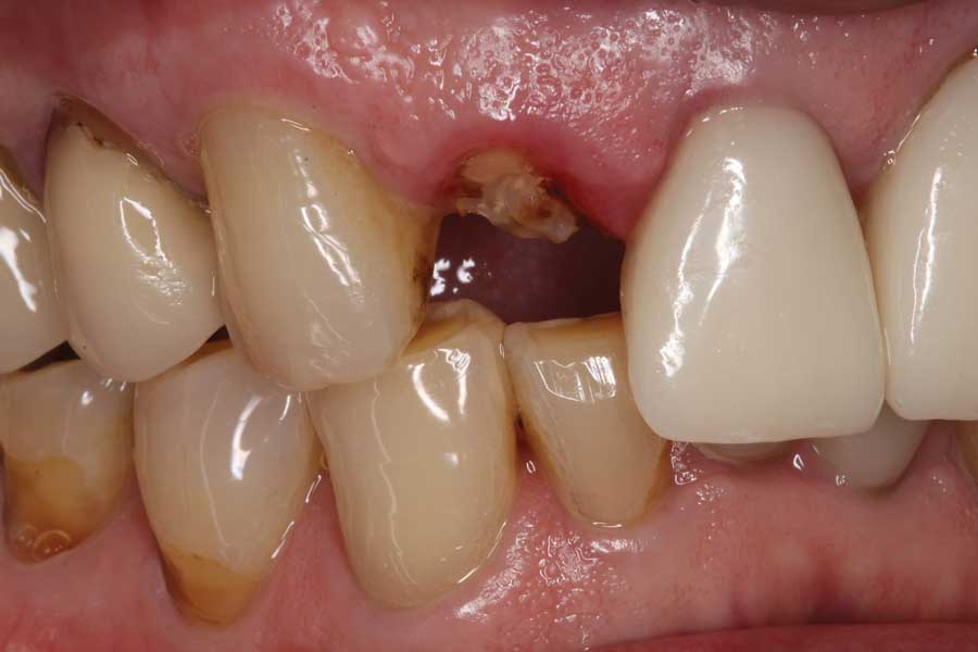 Immediate Implant Placement and Provisionalization Following Partial ...