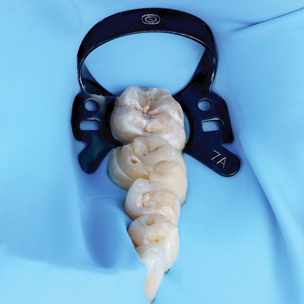 Preparation and Delivery of a Posterior Zirconia Crown | Inside Dentistry