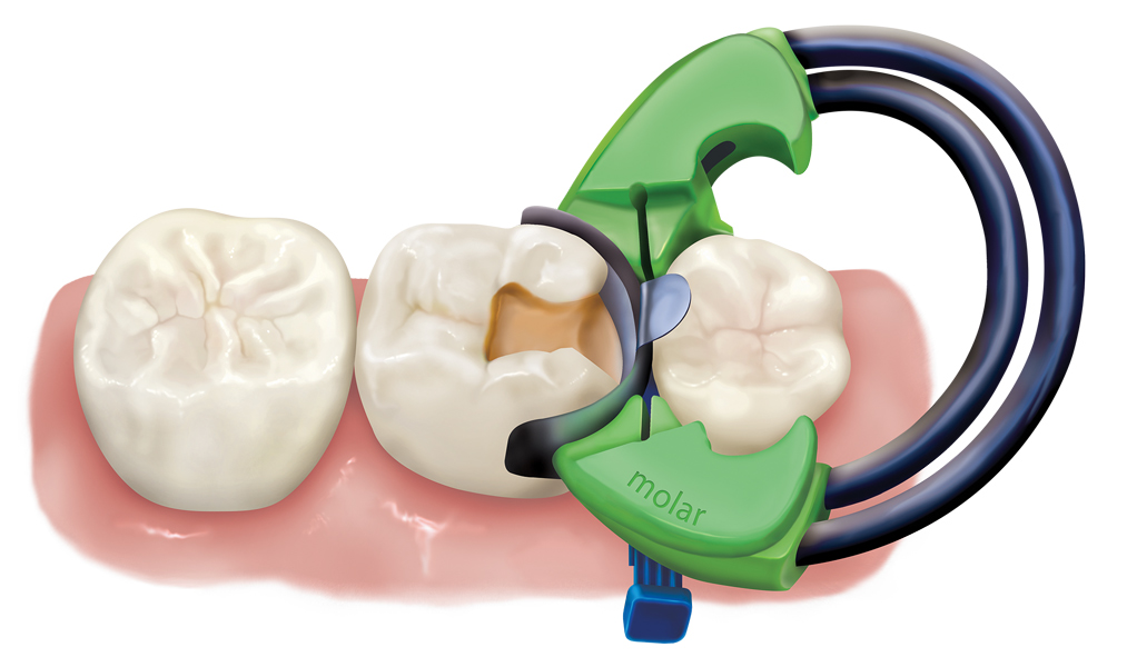 DualForce™ Sectional Matrix System | Inside Dentistry