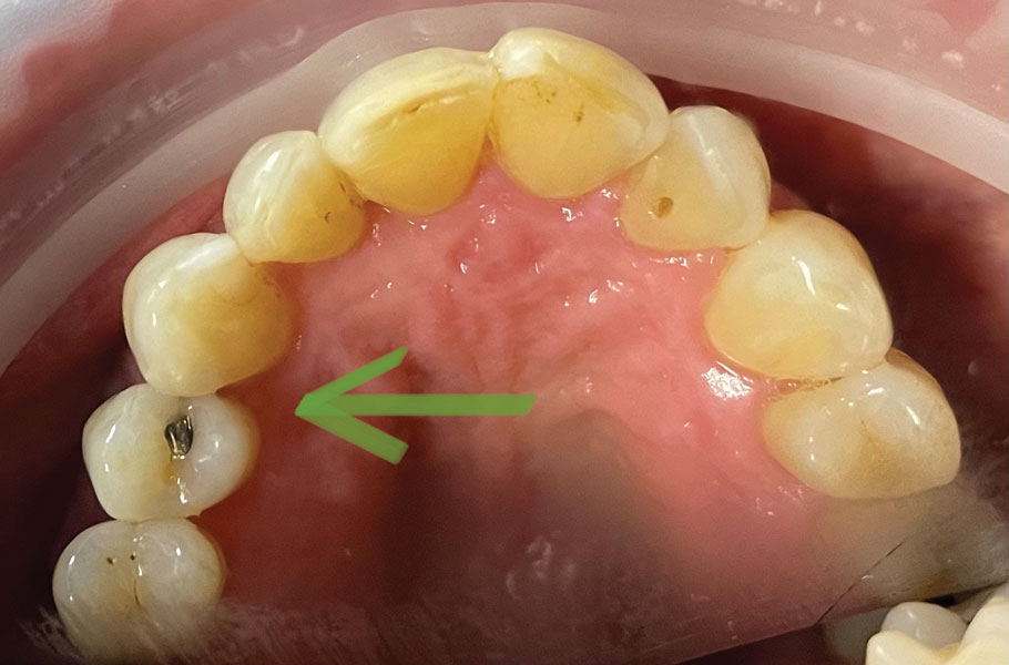 A Posterior Sectional Matrix System to Save the Day | Inside Dentistry