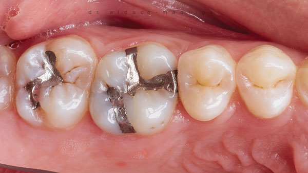 Re-treating Failed Posterior Amalgam Restorations | Inside Dentistry