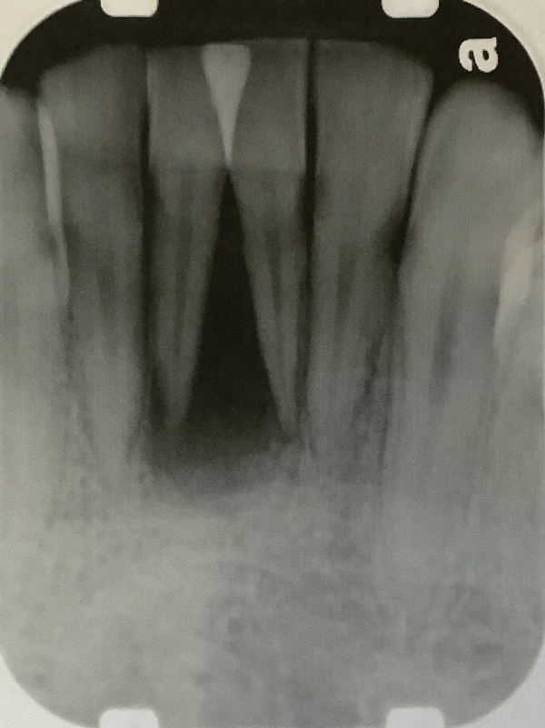 Periodontal Regeneration Therapy for Compromised Anterior Teeth ...