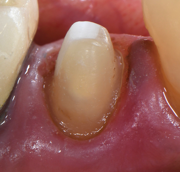 The Nonretentive Ceramic Overlay | Inside Dentistry