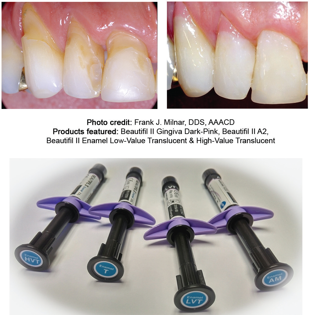 Beautifil II Enamel-colored Composites | Inside Dentistry