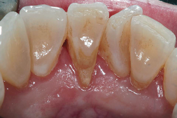 Treating Anterior Lingual Gingival Recession Defects | Inside Dentistry