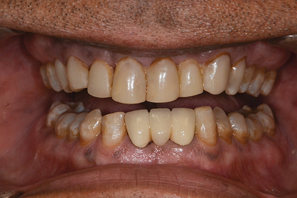 Transforming the Smile Line | Inside Dentistry