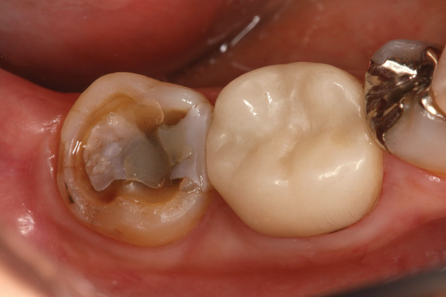 Restoring a Tooth With a Short Clinical Crown | Inside Dentistry