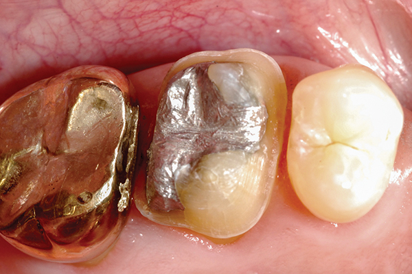 Polishing Interproximal Restorations with Limited Space | Inside Dentistry