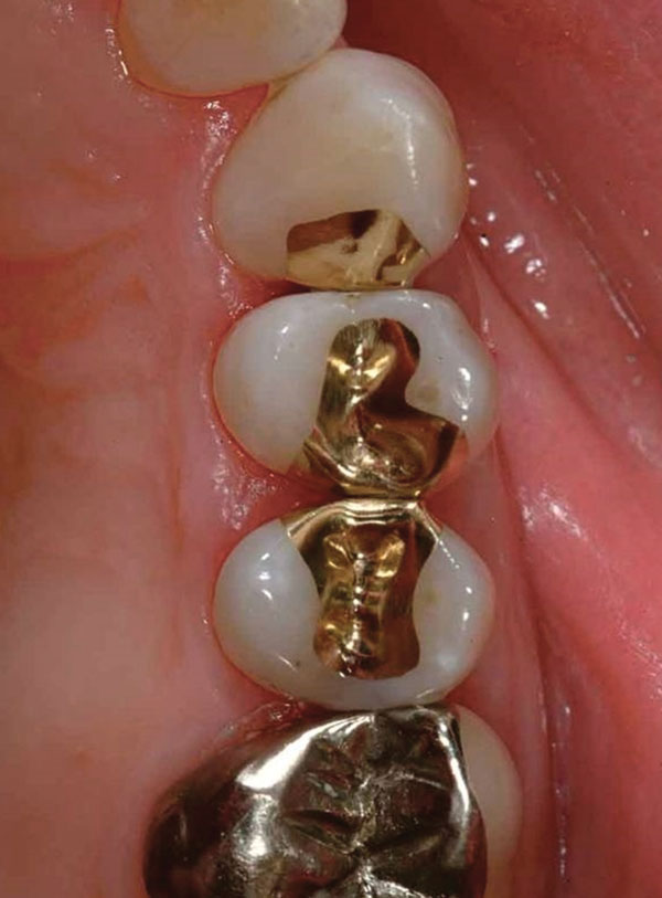 Conservative Cast Gold Inlays | Inside Dentistry