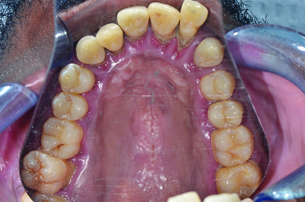 Treating Severe Chronic Periodontitis | Inside Dentistry