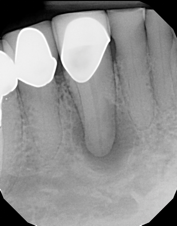 Successful Single-Cone Obturation | Inside Dentistry