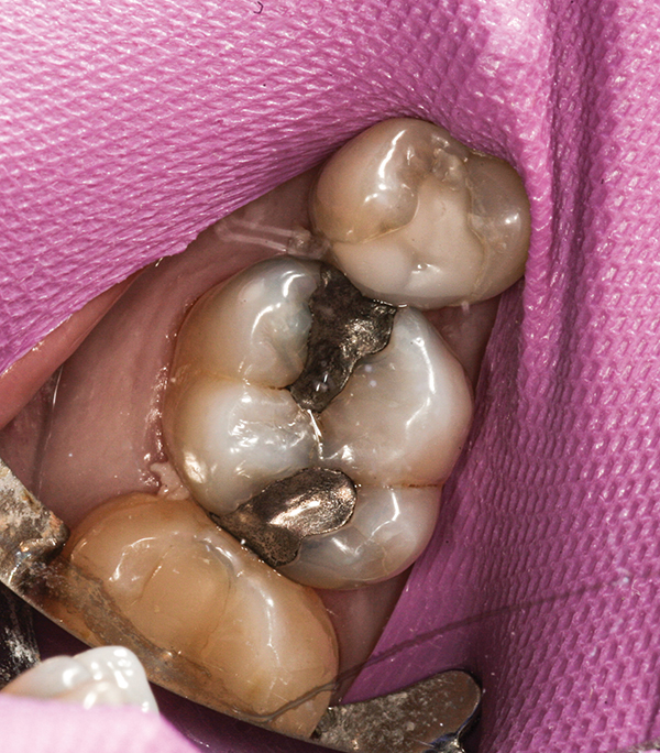 Enhancing Efficiency of Posterior Direct Composite Restorations ...