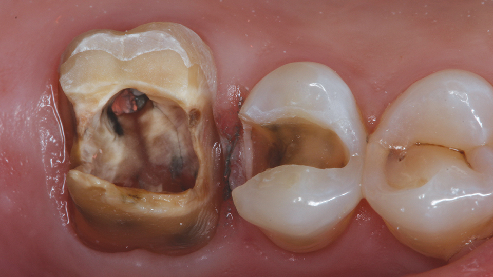 Strategies to Ensure the Bond Strength of Core Buildups | Inside Dentistry