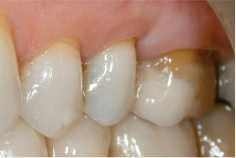 Custom Healing Abutment Fabrication Using Extracted Teeth | Inside ...