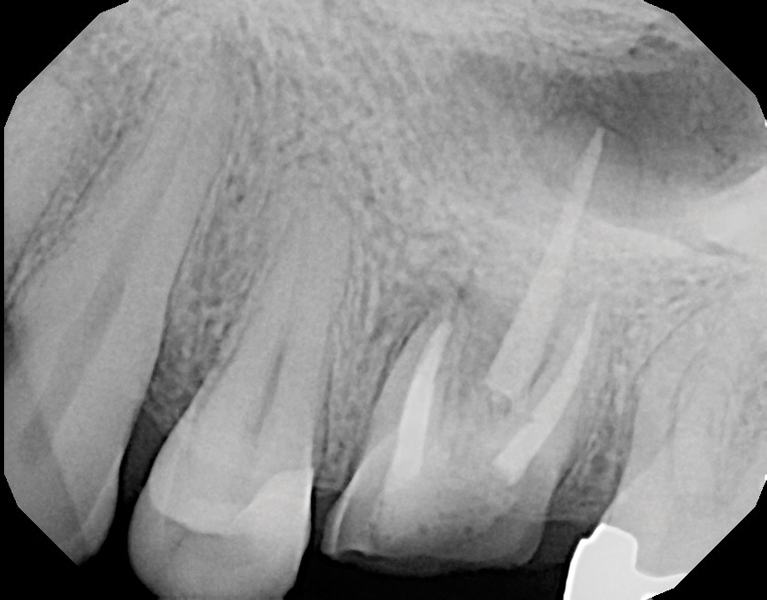 Innovations in Implantology | Inside Dentistry
