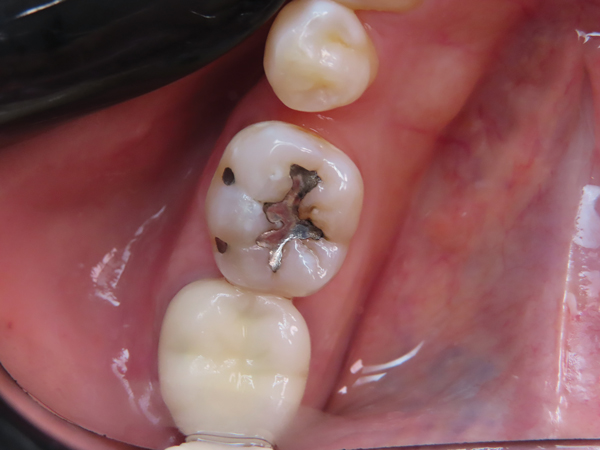 Amalgam Replacement Using a Universal Composite | Inside Dentistry
