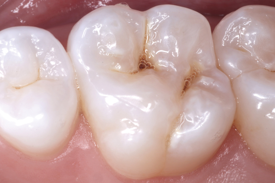 Protecting the Pulp in Deep Class I and II Restorations | Inside Dentistry